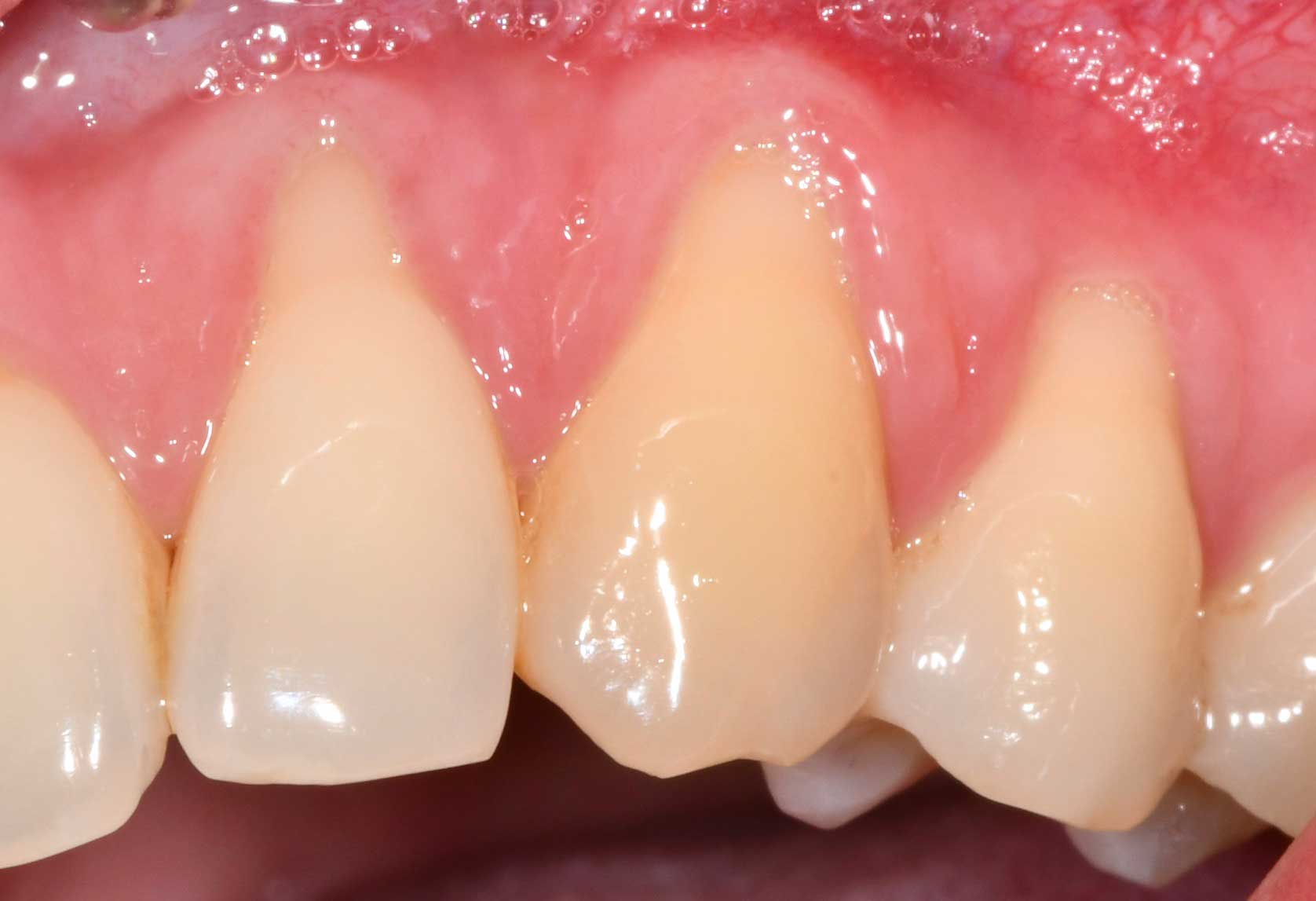 Gengive ritirate – Studio Dentistico Brighenti