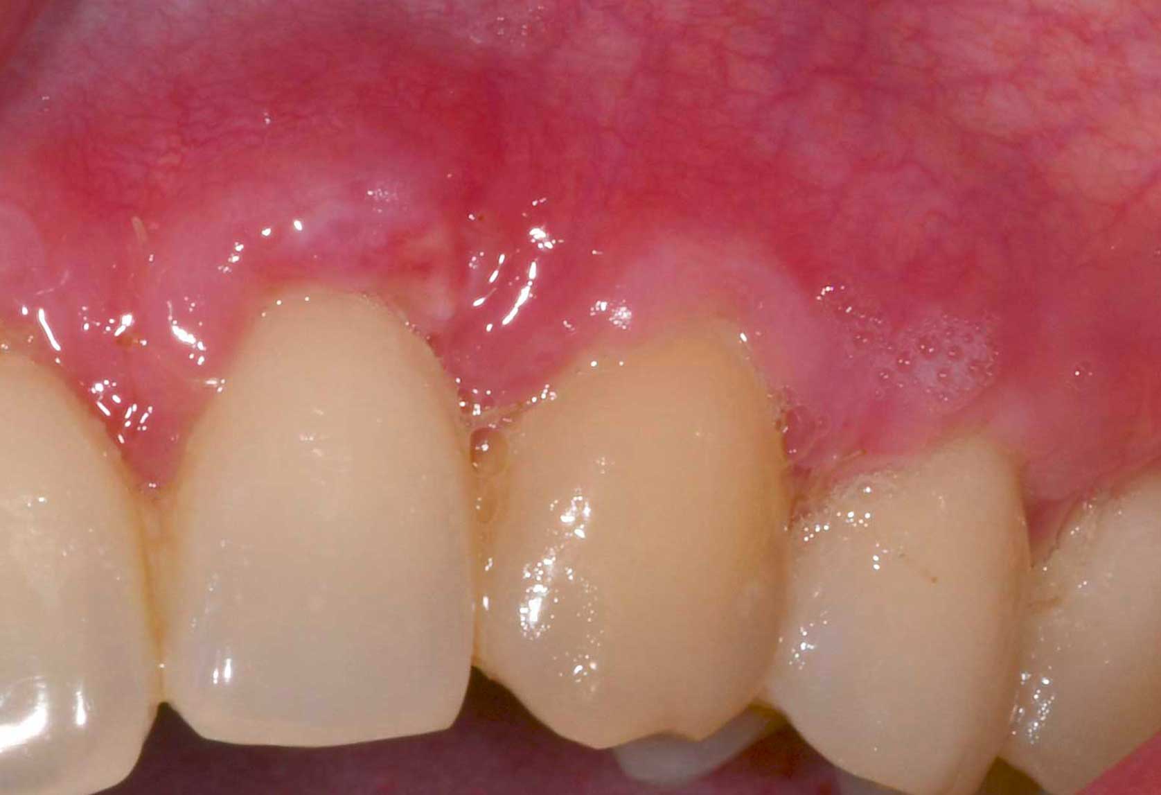 Gengive ritirate – Studio Dentistico Brighenti